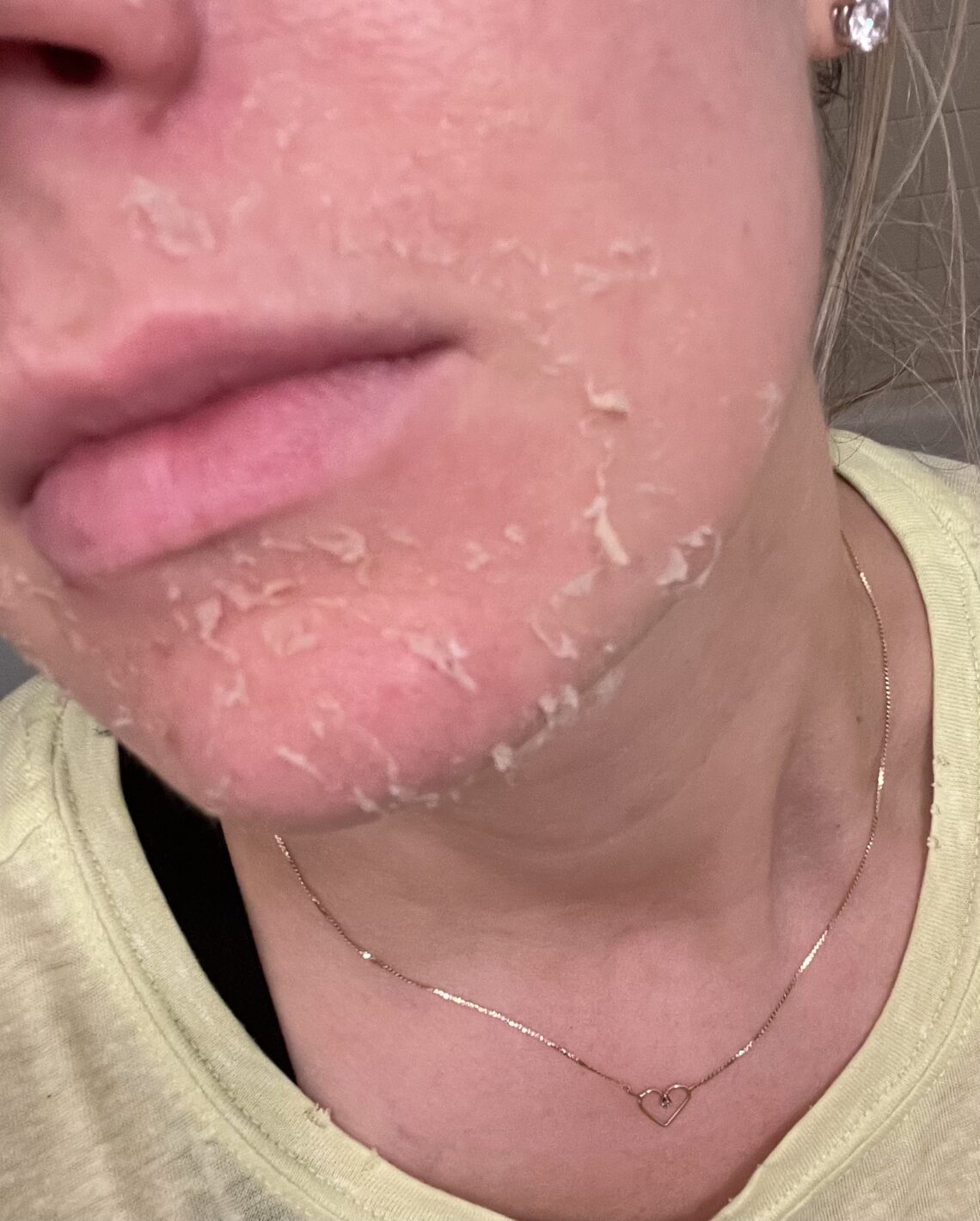 Everything you should know about a Chemical Peel - LoChandler.com